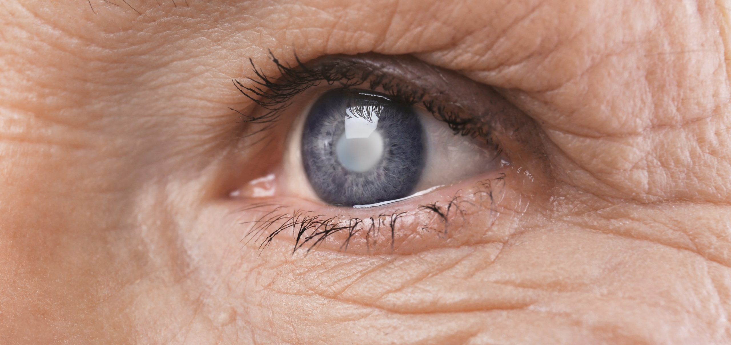 Types of Cataracts | Correct Vision Laser Institute | Hollywood ...